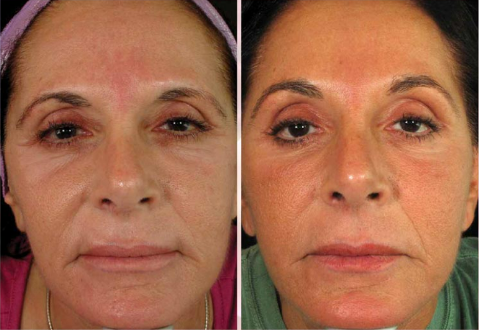 Vampire Facial | Facial Treatments|
